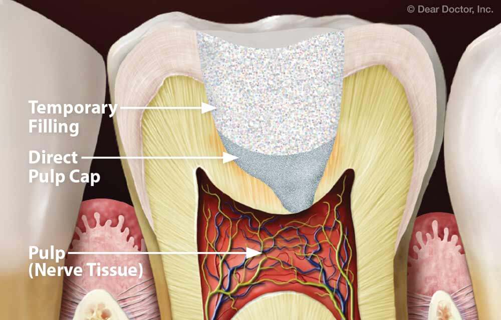 Indirect Pulp Capping - Atlas Dental