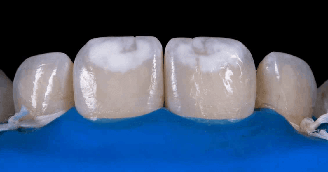 Indirect Pulp Capping - Atlas Dental