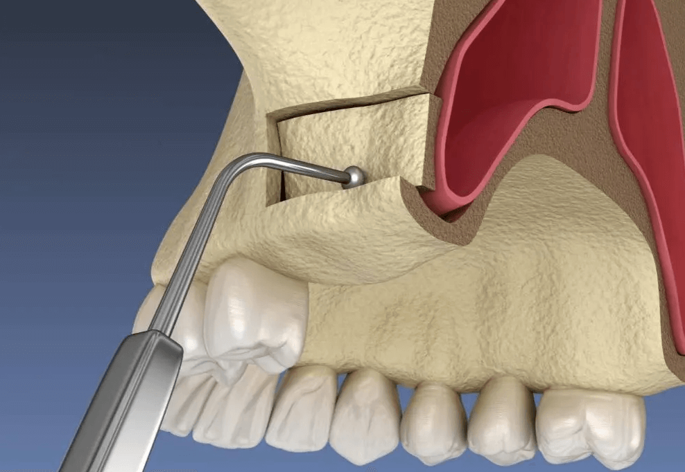 Lateral Window Sinus Lift in Toronto | Atlas Dental