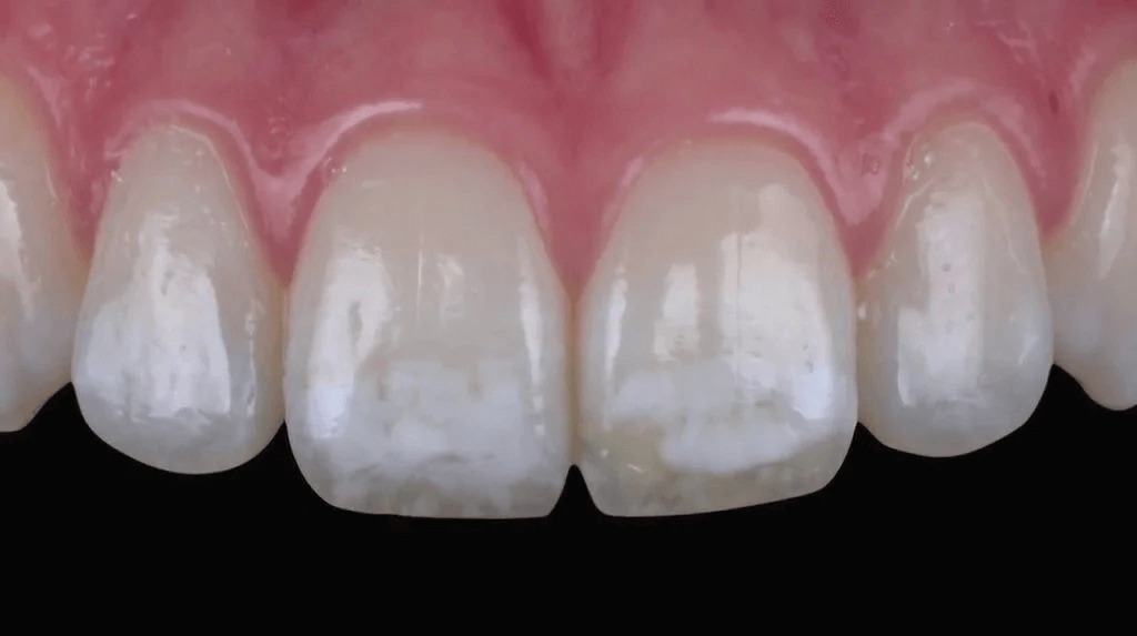 Dental Fluorosis: Symptoms, Causes & Treatment | Atlas Dental